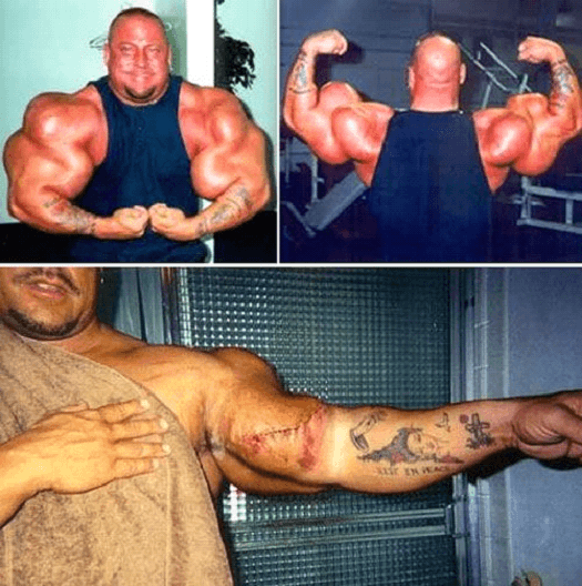Steroids Anabolic Steroids Side Effects Pictures HEALTH GYM GUIDE